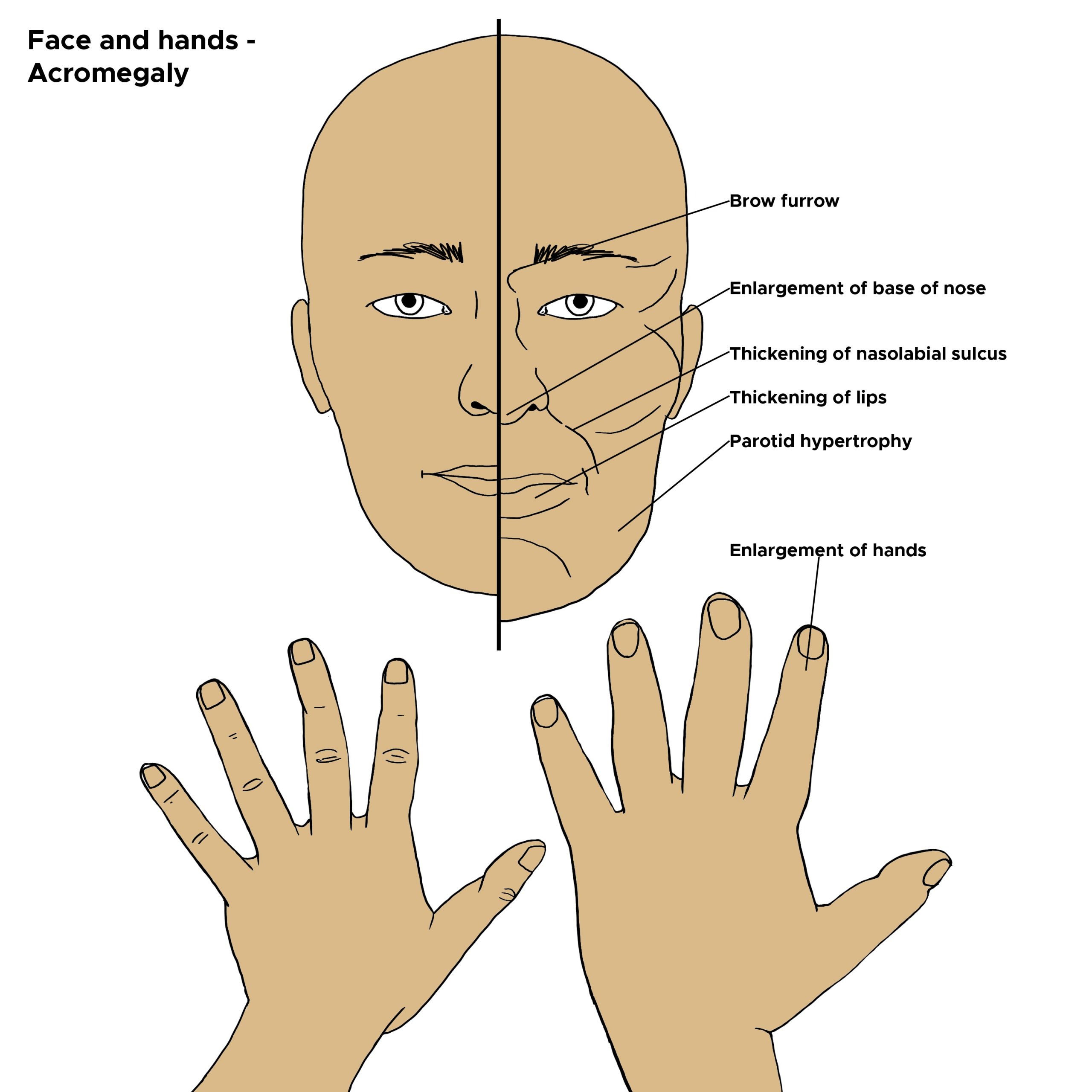 What Is Acromegaly MEDICINE FOR WORLD