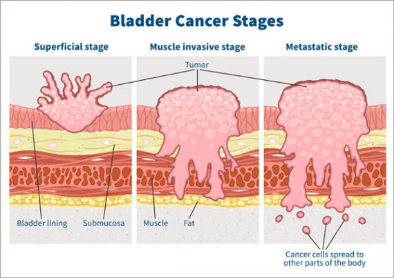 What is Bladder Cancer (Urothelial carcinoma)? - MEDICINE FOR WORLD