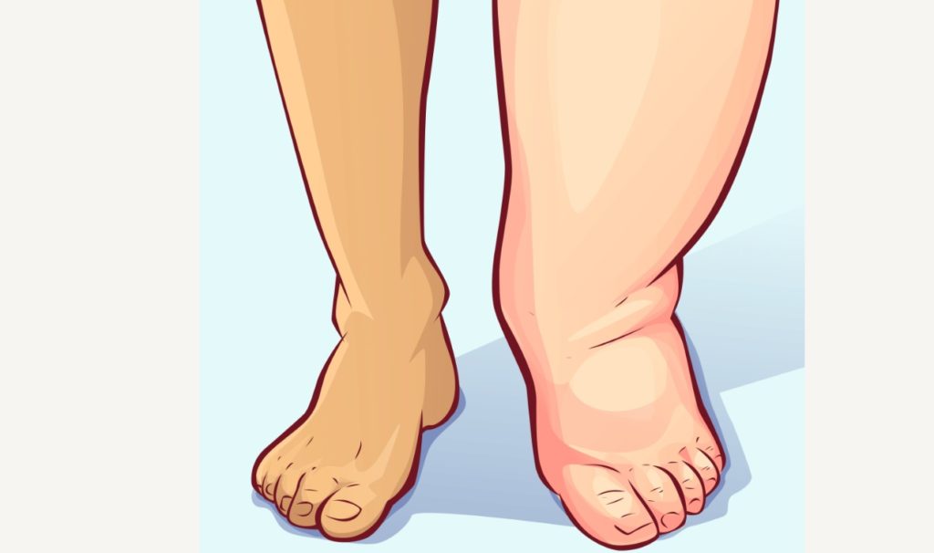 Swelling: Causes, Symptoms, and Treatment