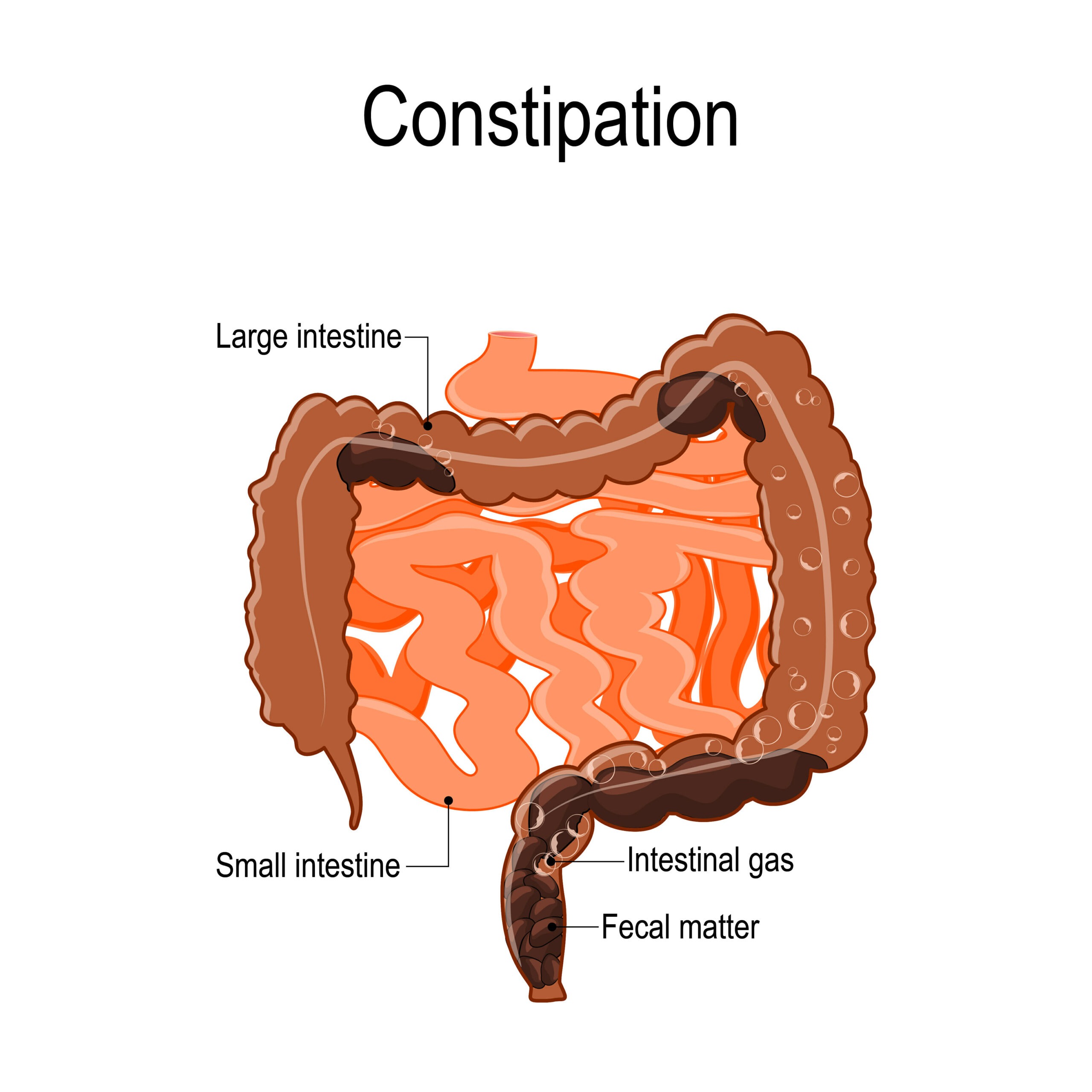 Constipation Causes, Symptoms, and Treatment