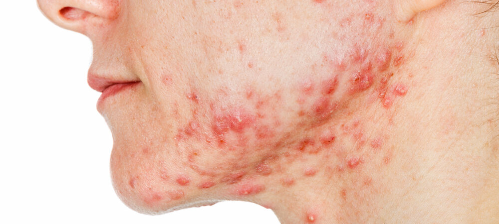 What is Acne Vulgaris? - MEDICINE FOR WORLD