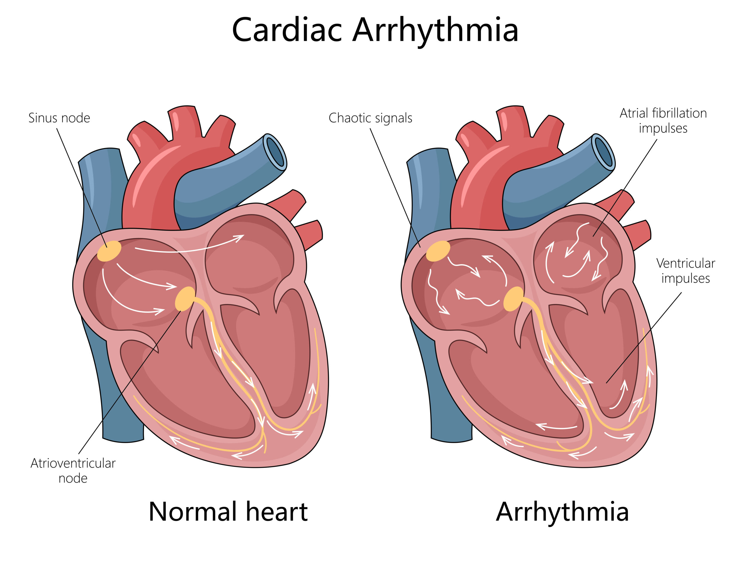 What is Arrhythmias? - MEDICINE FOR WORLD