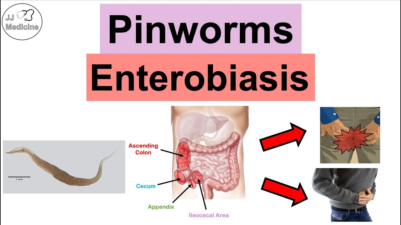 What is Enterobiasis? - MEDICINE FOR WORLD