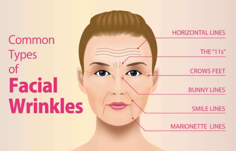 What is Facial Wrinkles? - MEDICINE FOR WORLD