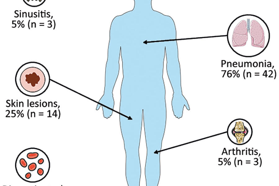 What Is Fusariosis? - MEDICINE FOR WORLD