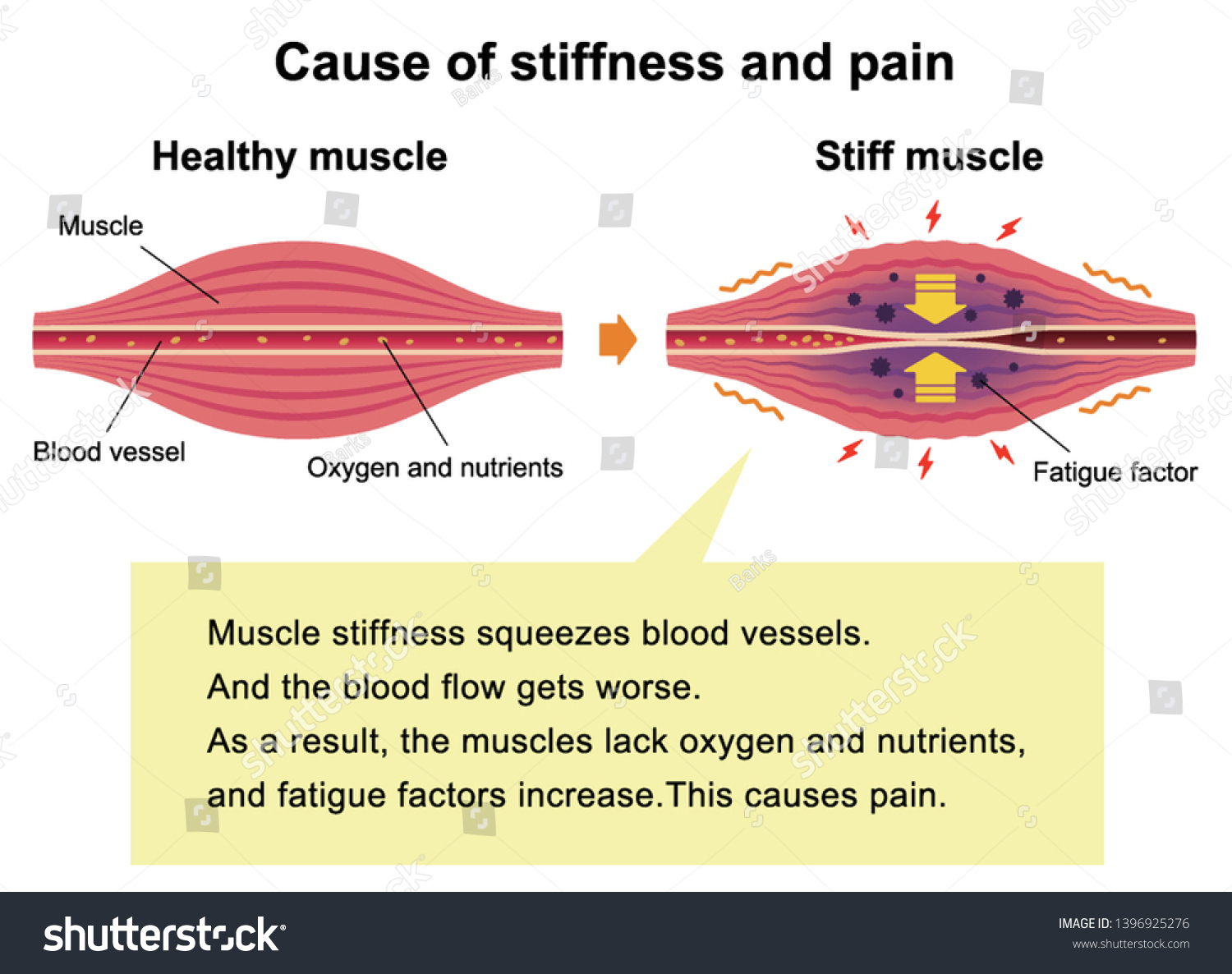 What is Stiffness? - MEDICINE FOR WORLD