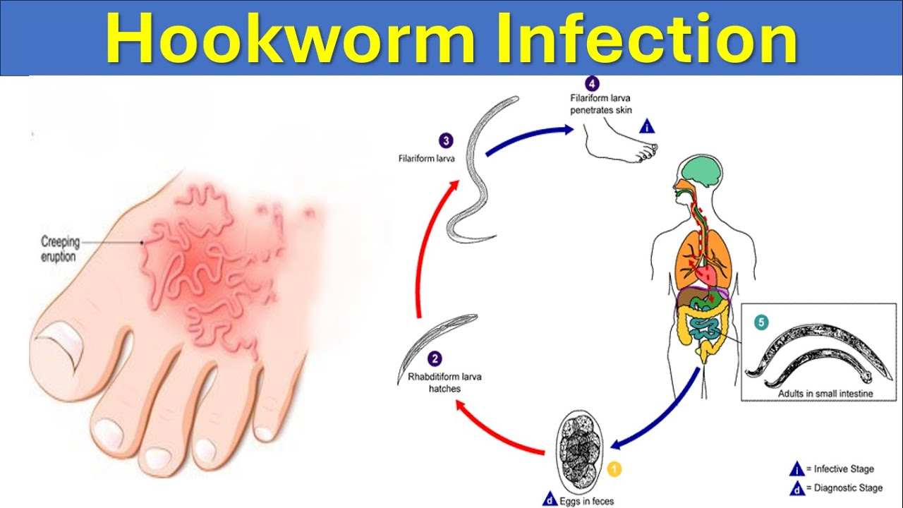 What is Hookworm Infections? - MEDICINE FOR WORLD