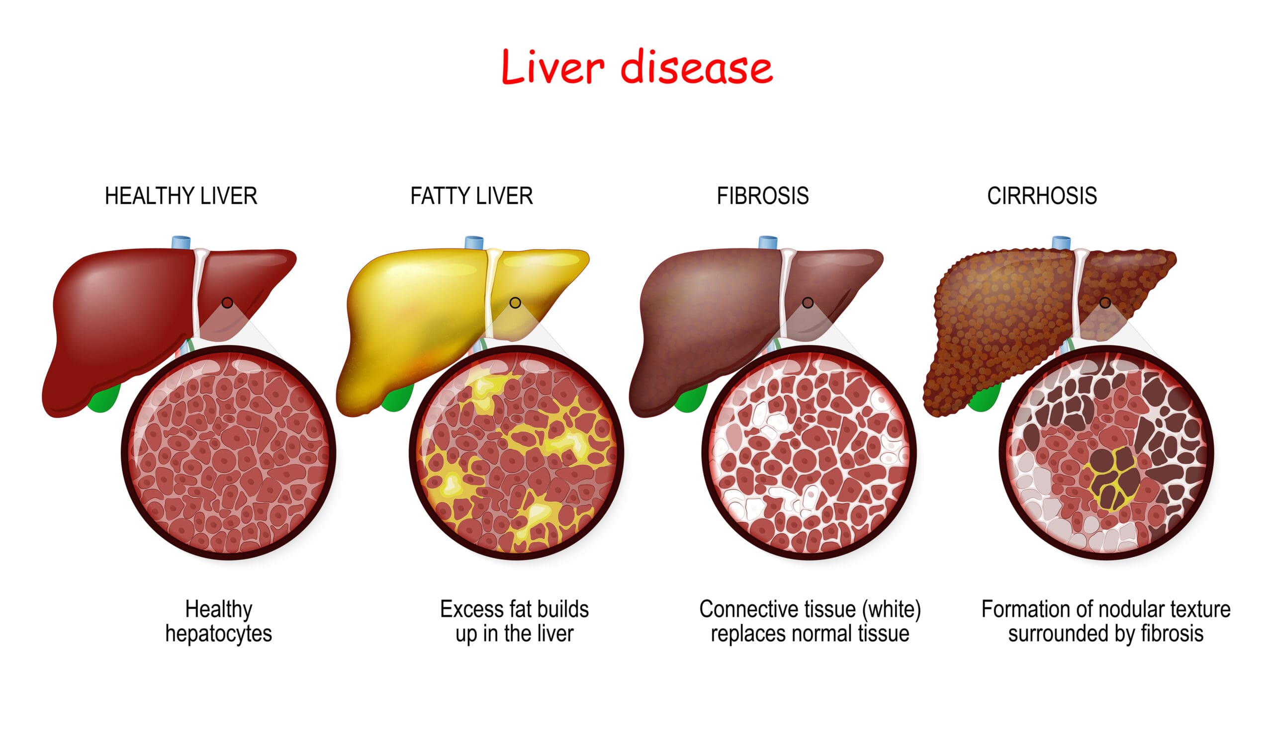 What is Liver Fibrosis? - MEDICINE FOR WORLD