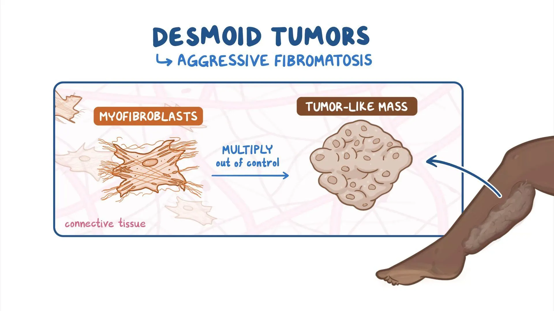 What is a Desmoid Tumor? - MEDICINE FOR WORLD